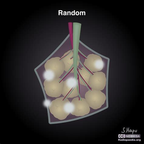 Random Pulmonary Nodules Pacs
