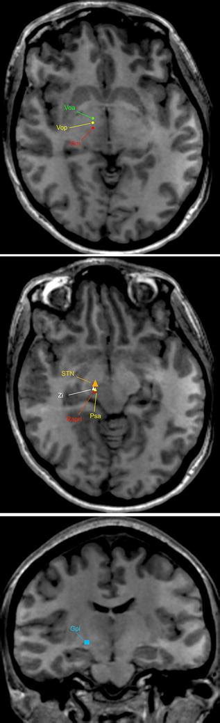 Main Dbs Targets For Uncommon Tremor Disorders Holmes Tremor Vim Download Scientific