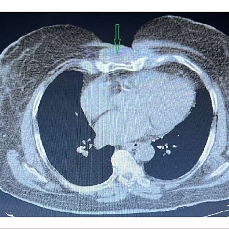Who Pie Chart About Breast Cancer Statistical Analysis Download