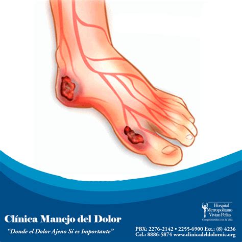 NeuropatÍa DiabÉtica Clínica Del Dolor Dr Javier Bravo Villalobos