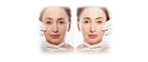 Brow Lift With BOTOX Aka BROWTOX SPARSH Hospital