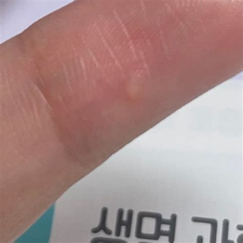 손가락에 작은 물집 지식in
