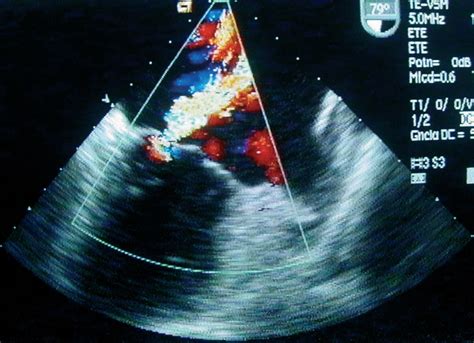 Severe Mitral Regurgitation In Libman Sacks Endocarditis Conservative Surgery Revista