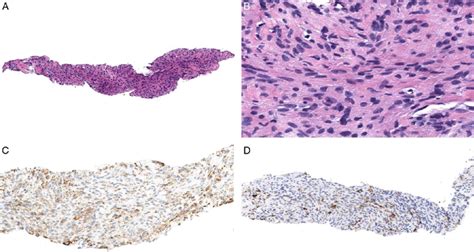 Case 3 The Needle Core Biopsy Of This Perirenal Mass Demonstrates A