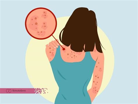 Acne Conglobata Treatment And Causes Remotederm