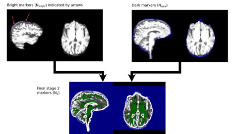 Figure 5 From Brain Extraction Using The Watershed Transform From Markers Semantic Scholar