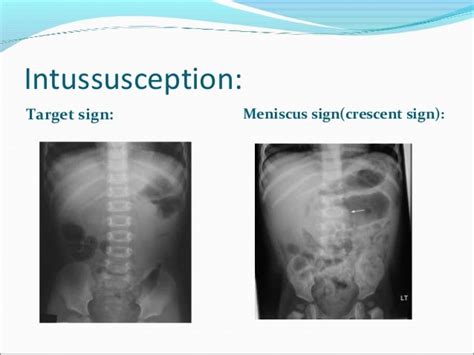 Intussusception X Ray Target Sign