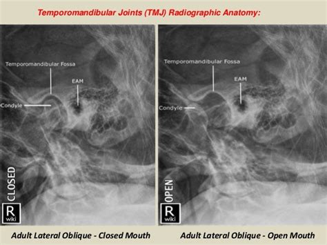 Presentation1 Pptx Radiological Anatomy Of The Temporo Mandibular Jo…