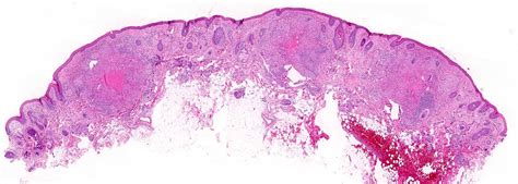 Pathology Outlines Lupus Miliaris Disseminatus Faciei Acne Agminata