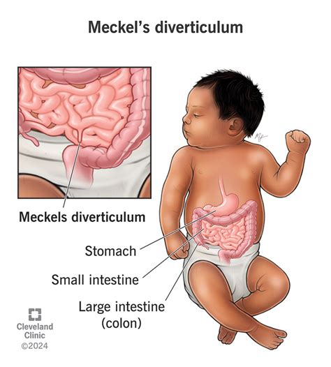 Diverticolo Di Meckel Sintomi Diagnosi E Trattamento Sfomc