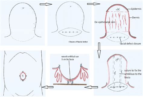 A Schematic Diagram Of The Procedure Download Scientific Diagram