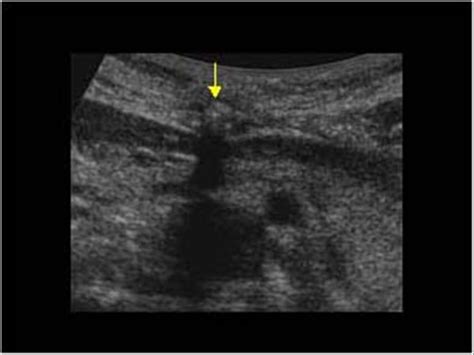 Thorax 8 4 Thoracic Wall Case 8 4 3 Anomalies Ultrasound Cases