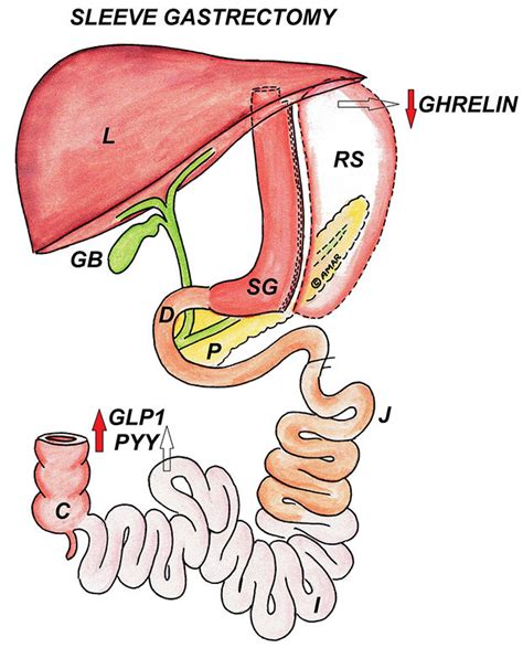 Laparoscopic Sleeve Gastrectomy Download Scientific Diagram