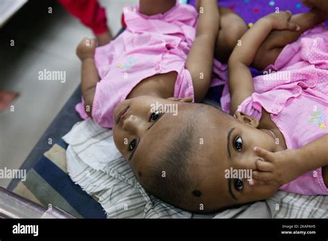 Siamese Twins Head Attached