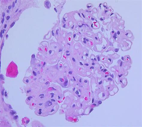Photomicrograph Of A Representative Glomerulus From The Renal Biopsy Download Scientific