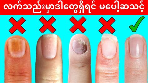 လက်သည်းမှာ ဒီ ၈ မျိုးရှိနေရင် ဆရာဝန်ချက်ချင်းပြပါ ‼️ ကင်ဆာ၊ နှလုံးရောဂါ၊ အသည်းခြောက် Youtube