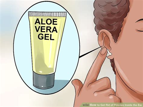 Ways To Get Rid Of Pimples Inside The Ear WikiHow