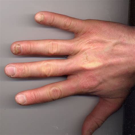 Artrita Psoriazica Cauze Si Tratament Bodygeek