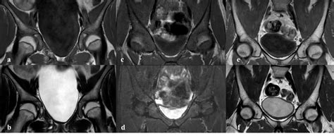 Pelvic Bone Mri In The Coronal Plane A B A Healthy Control Without