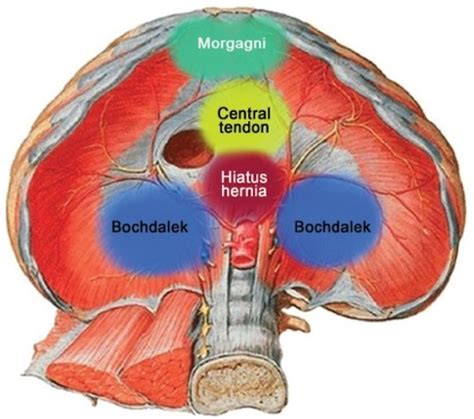 Diaphragmatic Hernia
