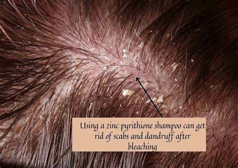 6 Tips On How To Treat Scabs On Scalp From Bleach 2024 Treatments For Bleach Burns Sores