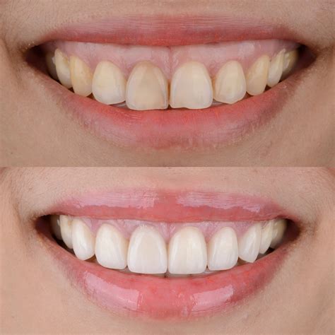 Crown Lengthening Crown Dental