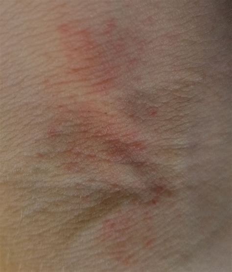 Eczema And Dermatitis Types Symptoms And Treatment Online Ai