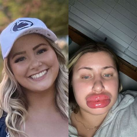 Huge Swollen Lips Allergic Reaction At Alannah Gosling Blog