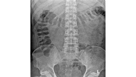 Crohns Disease With Abdominal Pain Physicians Weekly