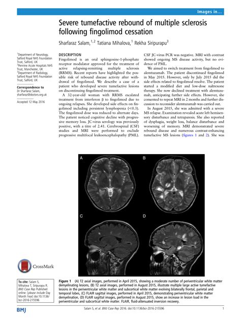 Pdf Tumefactive Rebound Of Multiple Sclerosis Following Cessation Of Fingolimod