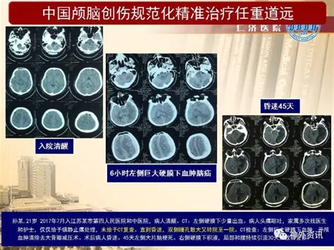 《柳叶刀神经病学杂志专刊》特别专访丨江基尧教授：多途径整合提高全球颅脑创伤防治和研究水平 脑医汇