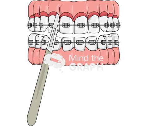 Supracrestal Circumferential Fiberotomy