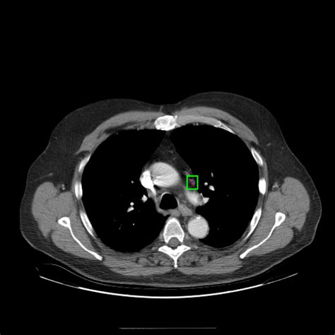 Lung Cancer Detection Using Yolo V Object Detection Dataset V Pm By Canceremjeg
