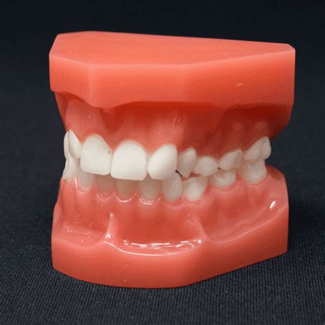 Orthodontics Class 2 Division 2 At Abigail Schardt Blog