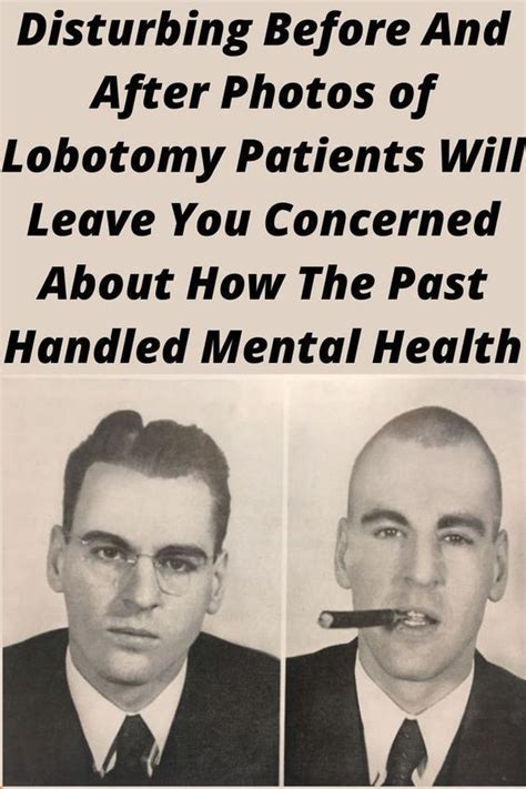 Disturbing Before And After Photos Of Lobotomy Patients Will Leave You