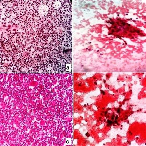 1a Reactive Hyperplasia Of Lymphnode Showing Lymphoid Cells In Download Scientific Diagram