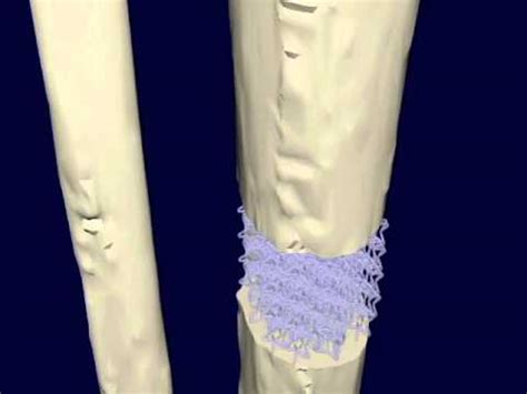 Auxetic Scaffold Prototype In Bone YouTube