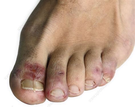 Chilblains On The Toes Stock Image C016 6855 Science Photo Library