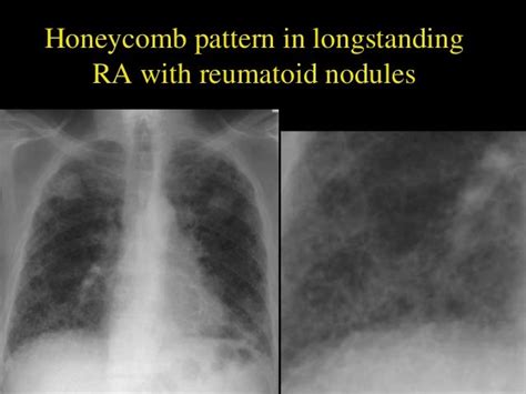 Helpful Radiological Signs In Cxr25 11 91