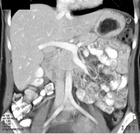 Gastric Lipoma Stomach Case Studies Ctisus Ct Scanning