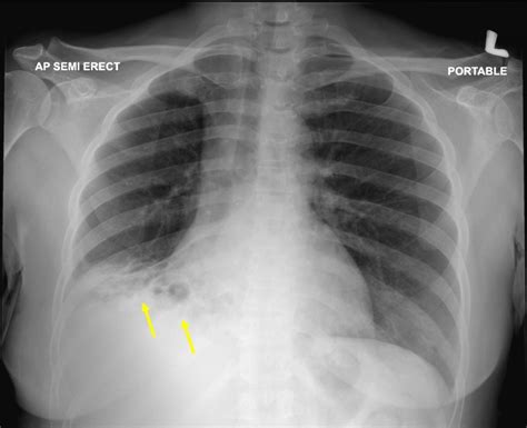 Bronchiectasis X Ray