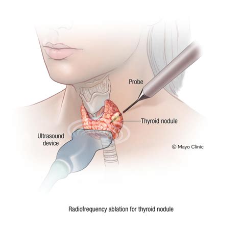 Mayo Clinic Minute Treating Thyroid Nodules Without Surgery Mayo Clinic News Network