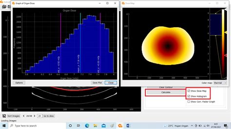 An Example Of A Dose Map Dm And An Organ Histogram Of The Dose