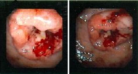 Figure 1 From Infectious Endocarditis Due To Streptococcus Bovis In A