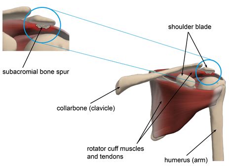 Subacromial Shoulder Impingement Syndrome Subacromial Impingement