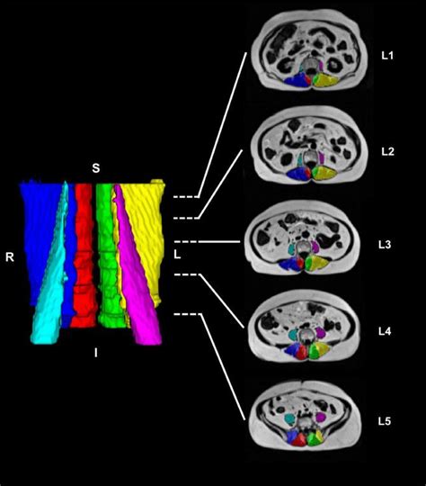 Investigating The Associations Between Lumbar Paraspinal Muscle Health