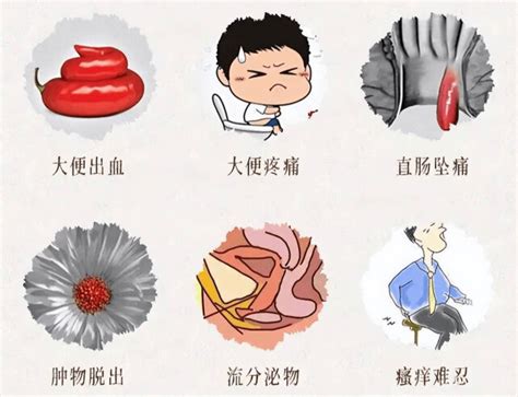 得了痔疮怎么办?三个动作加四步方法,快速解决痔疮问题 哔哩哔哩 得了痔疮怎么办?三个动作加四步方法,快速解决痔疮问题 哔哩哔哩