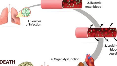 What Ems Needs To Know About New Pediatric Sepsis Guidelines