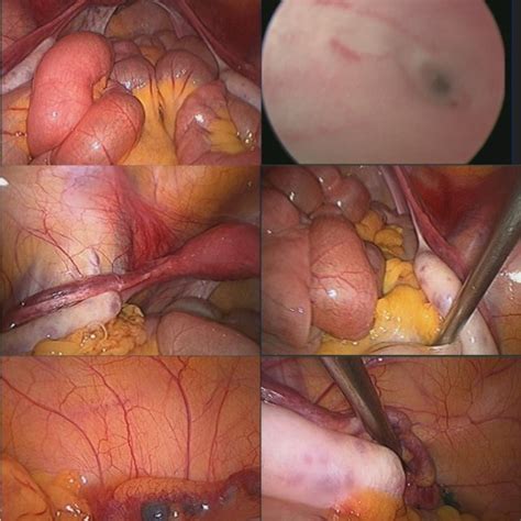 Exploratory Laparoscopy Of Case 1 Exploratory Laparoscopy Showed That