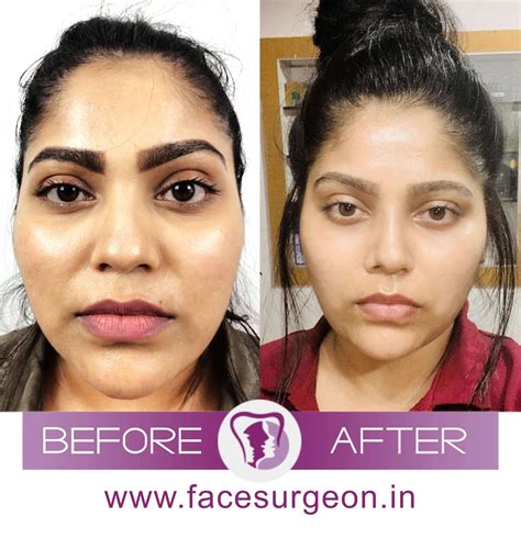 Nose Bridge Surgery For A Depressed Nasal Bridge Richardson S Plastic Surgery Hospitals